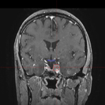 Hypophysen Adenom Erfahrungsberichte – GVJGVD